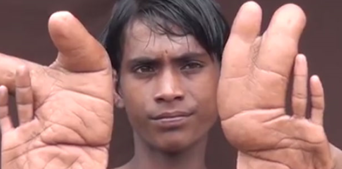 Sus enormes manos no lo dejan vivir una vida normal